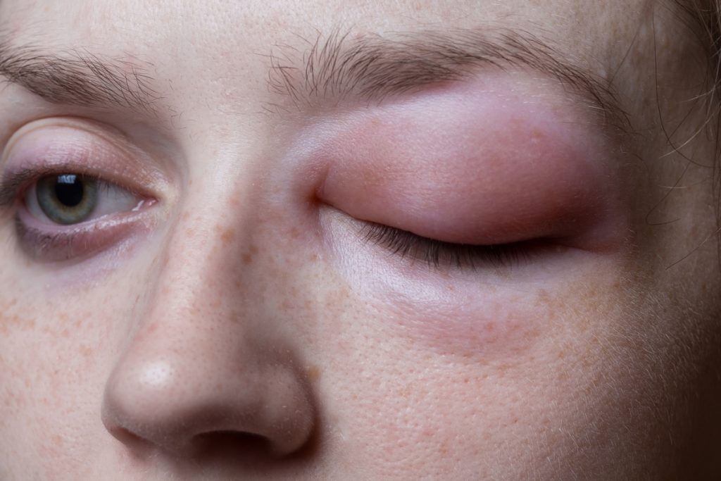 Angioedema Types Symptoms And Treatments BVAAC Dr Paul Jantzi