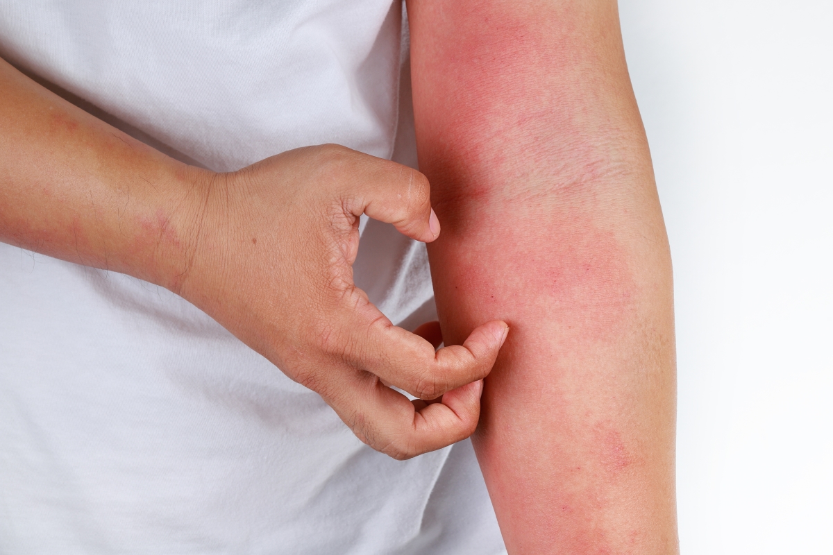 Anaphylaxis Allergy: Causes, Symptoms, Diagnosis, and Treatments